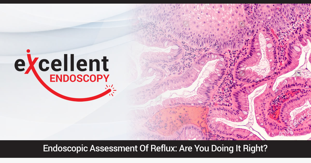 Endoscopic Assessment Of Reflux: Are You Doing It Right? - News ...